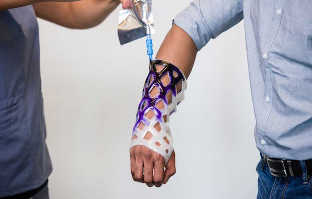 Revolutionary new orthopaedic cast is lightweight, waterproof and ...